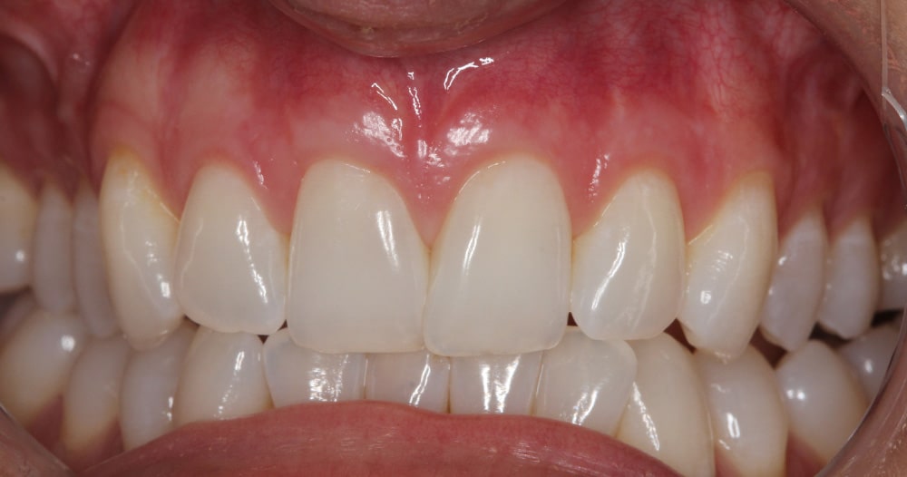 Soft Tissue Gum Graft | Before & After | Periodontist NYC