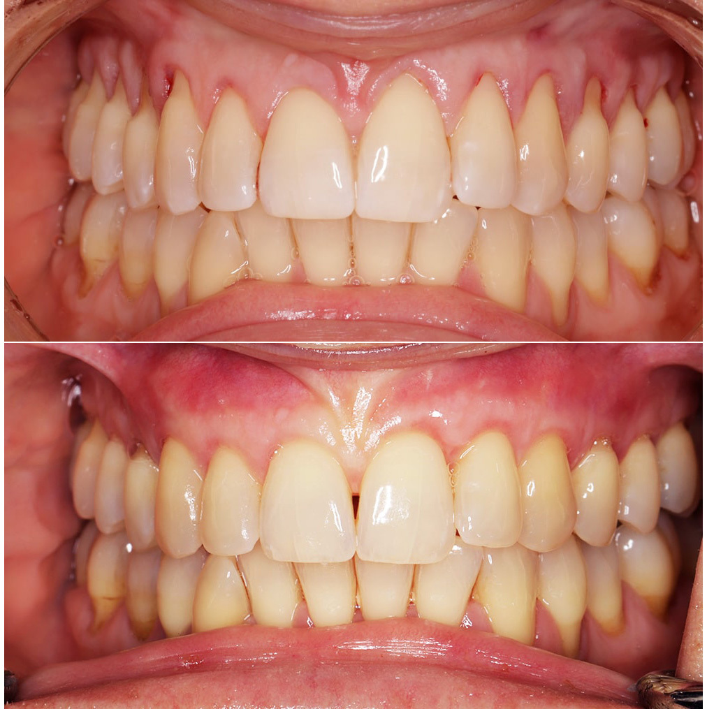 Soft Tissue Gum Graft Before After Periodontist NYC