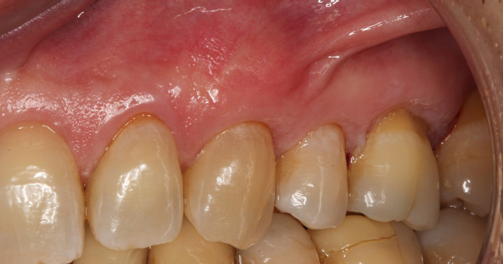 Soft Tissue Gum Graft | Before & After | Periodontist NYC