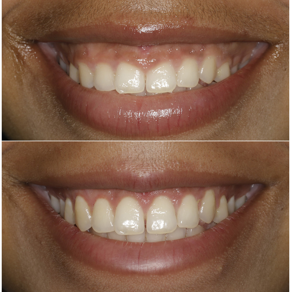Soft Tissue Gum Graft | Before & After | Periodontist NYC