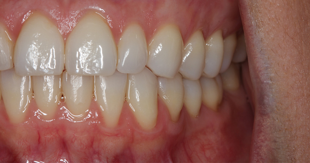 Soft Tissue Gum Graft | Before & After | Periodontist NYC