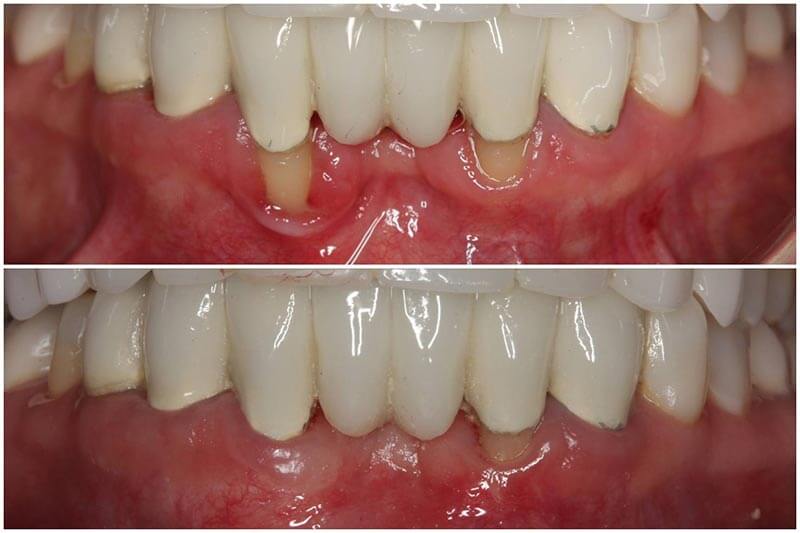 Gum Graft Before Or After _ Gum Graft Treatment – OHYDHC