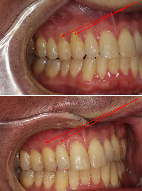 Soft Tissue Gum Graft | Before & After | Periodontist NYC