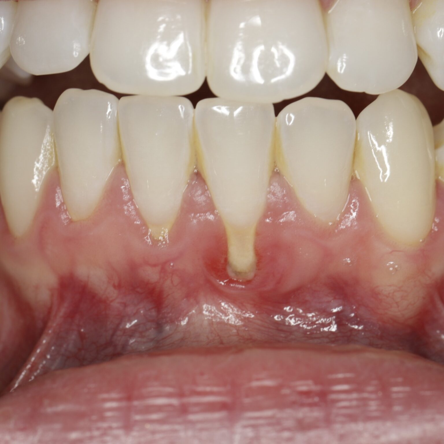 Gum Grafting NYC | Gum Surgery - New York Periodontist | Dr. Rahmani