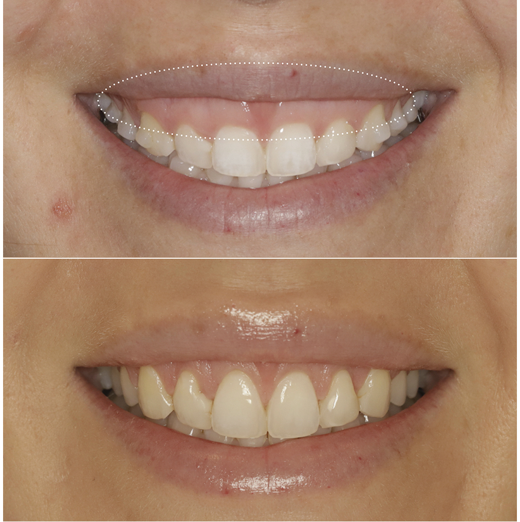 Crown Lengthening Procedure in Midtown Manhattan, NYC