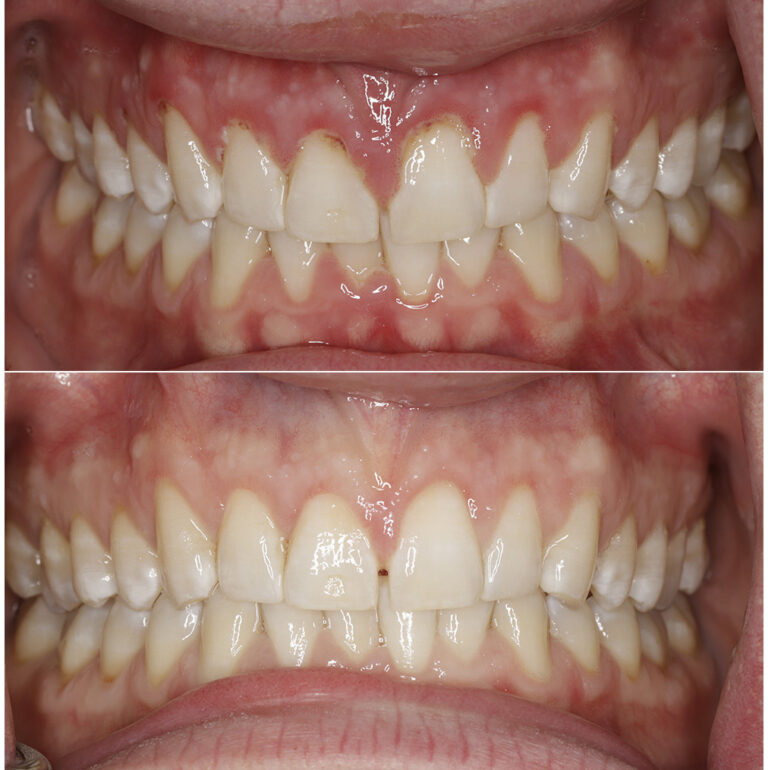 LANAP Gum Disease Treatment Manhattan, NY