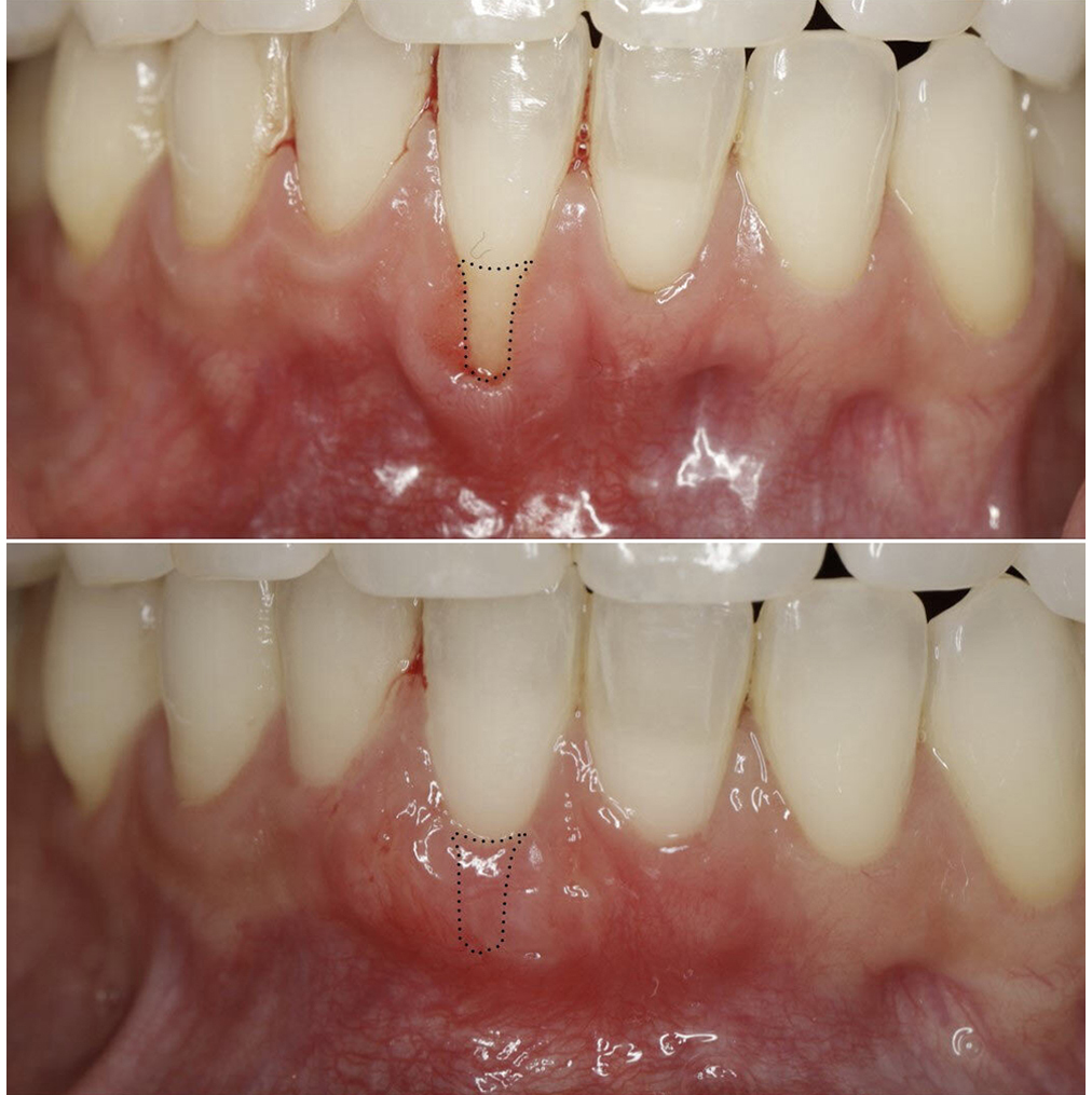 Soft Tissue Gum Graft Before After Periodontist NYC