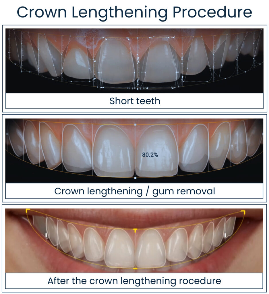 Crown Lengthening Procedure in Midtown Manhattan, NYC